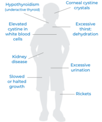 Cystinosis Causes, Symptoms, Eye Effects & Treatment